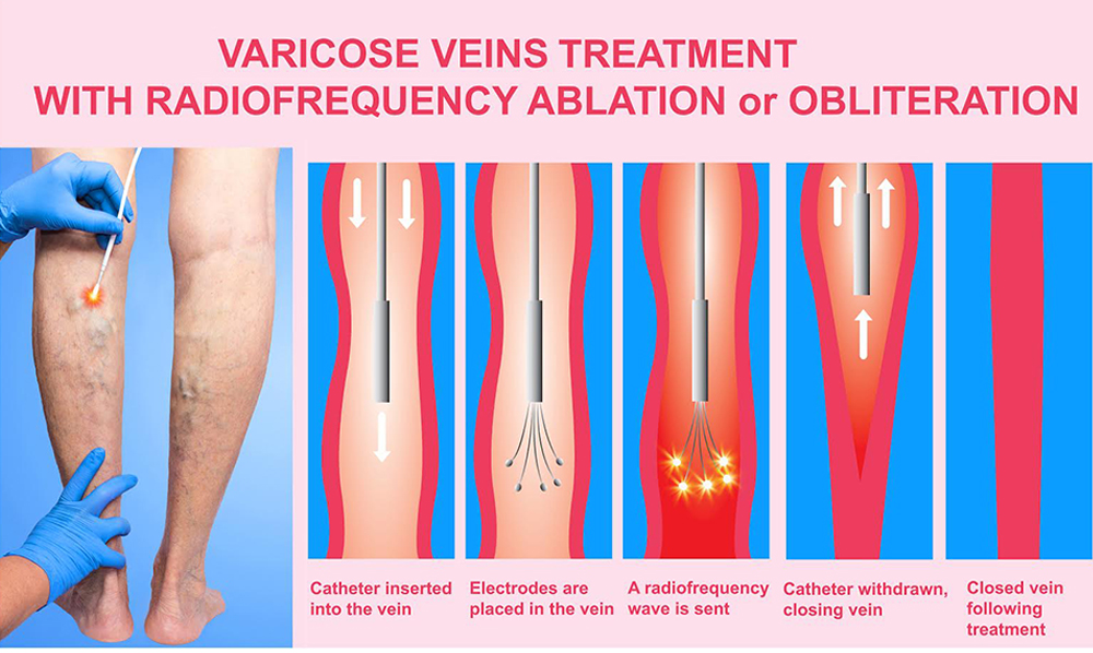 TREATMENT Advanced Cardiovascular Institute